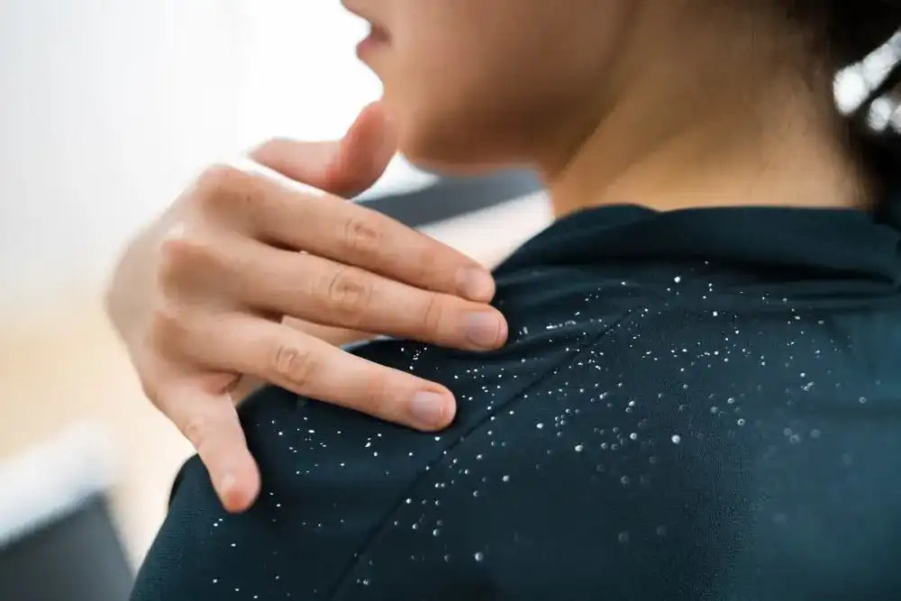 Say Goodbye to Teenage Dandruff With This Easy Routine – YPlayZ